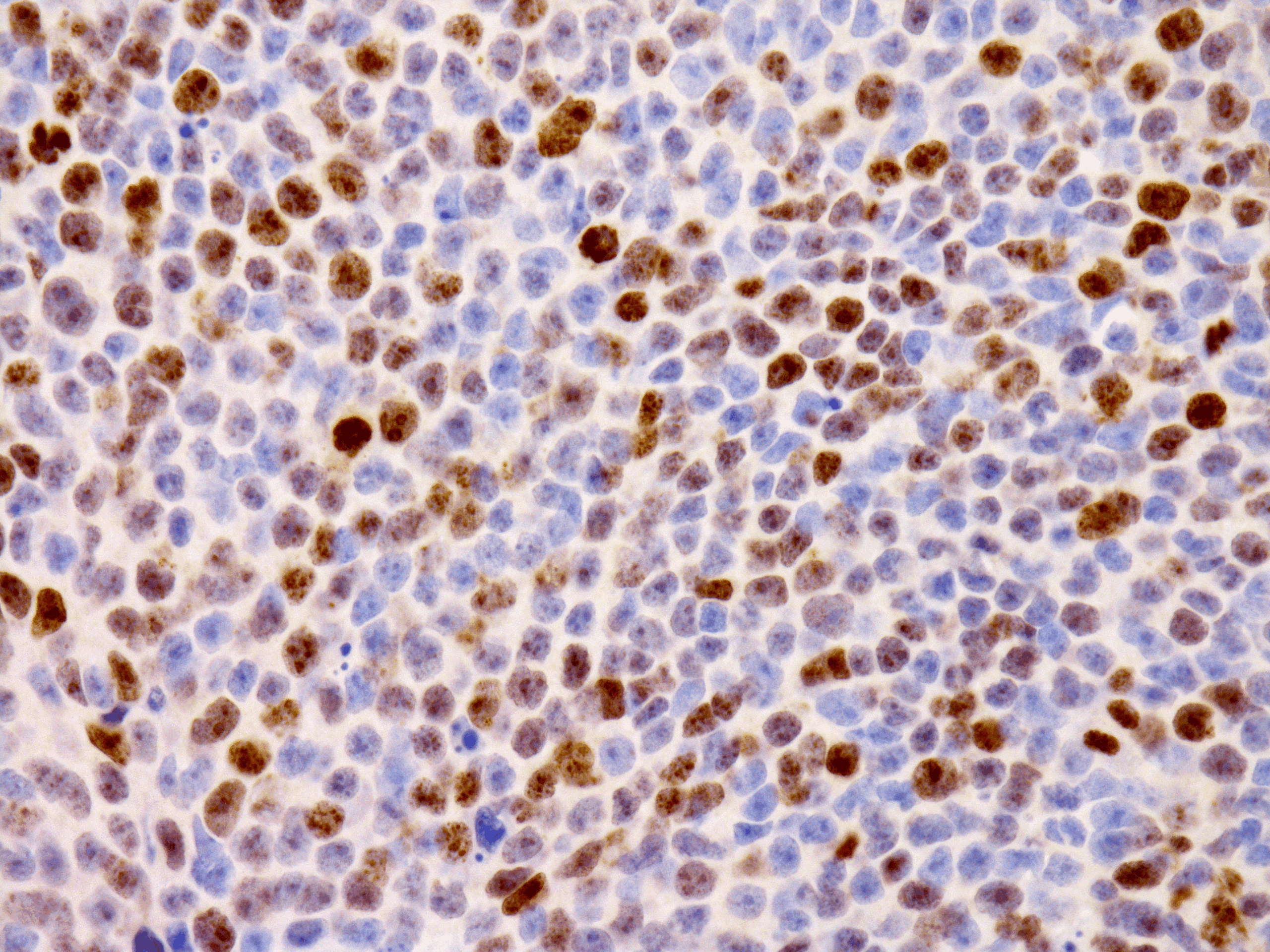 R2 Genomics Analysis and Visualization Platform: Pediatric PDX (Olson)